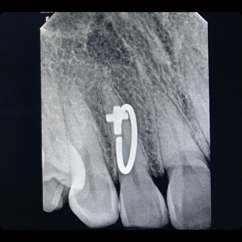 10 Fascinating Pictures of Body Jewelry in X-Rays – BodyCandy