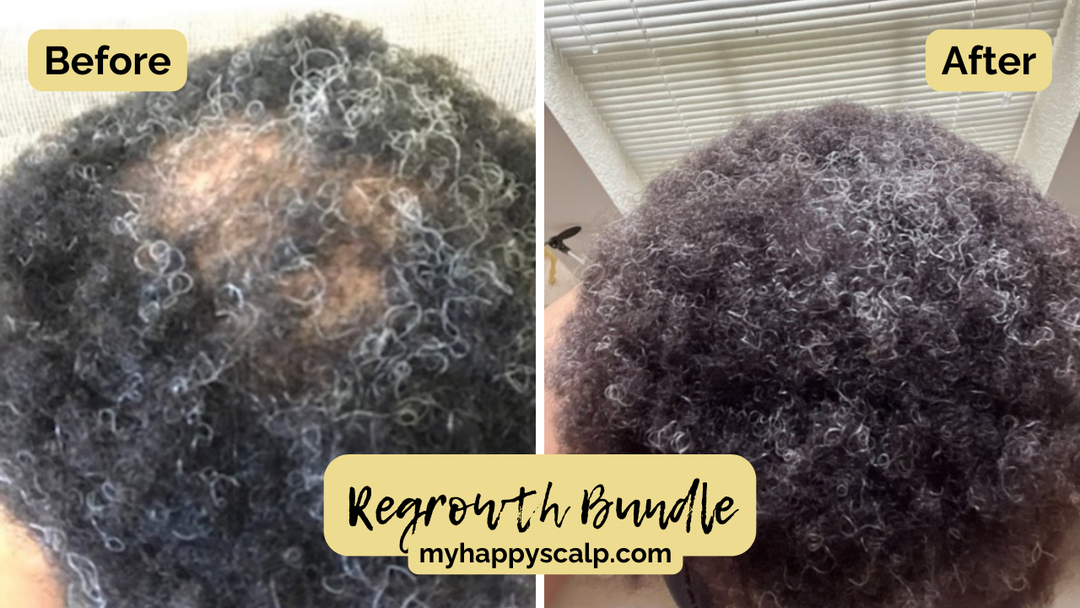 Natural Regrowth Bundle - Fight Hair Loss and Regrow Your Hair!