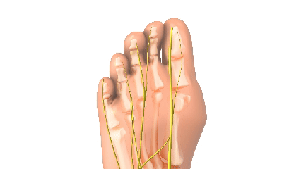 What Is Morton's Neuroma? Causes, Symptoms, Treatment, and Avoiding Su ...