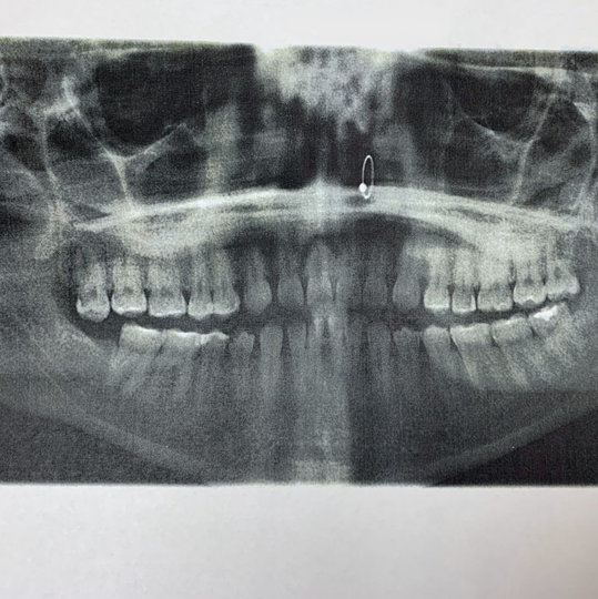 10 Fascinating Pictures of Body Jewelry in X-Rays – BodyCandy