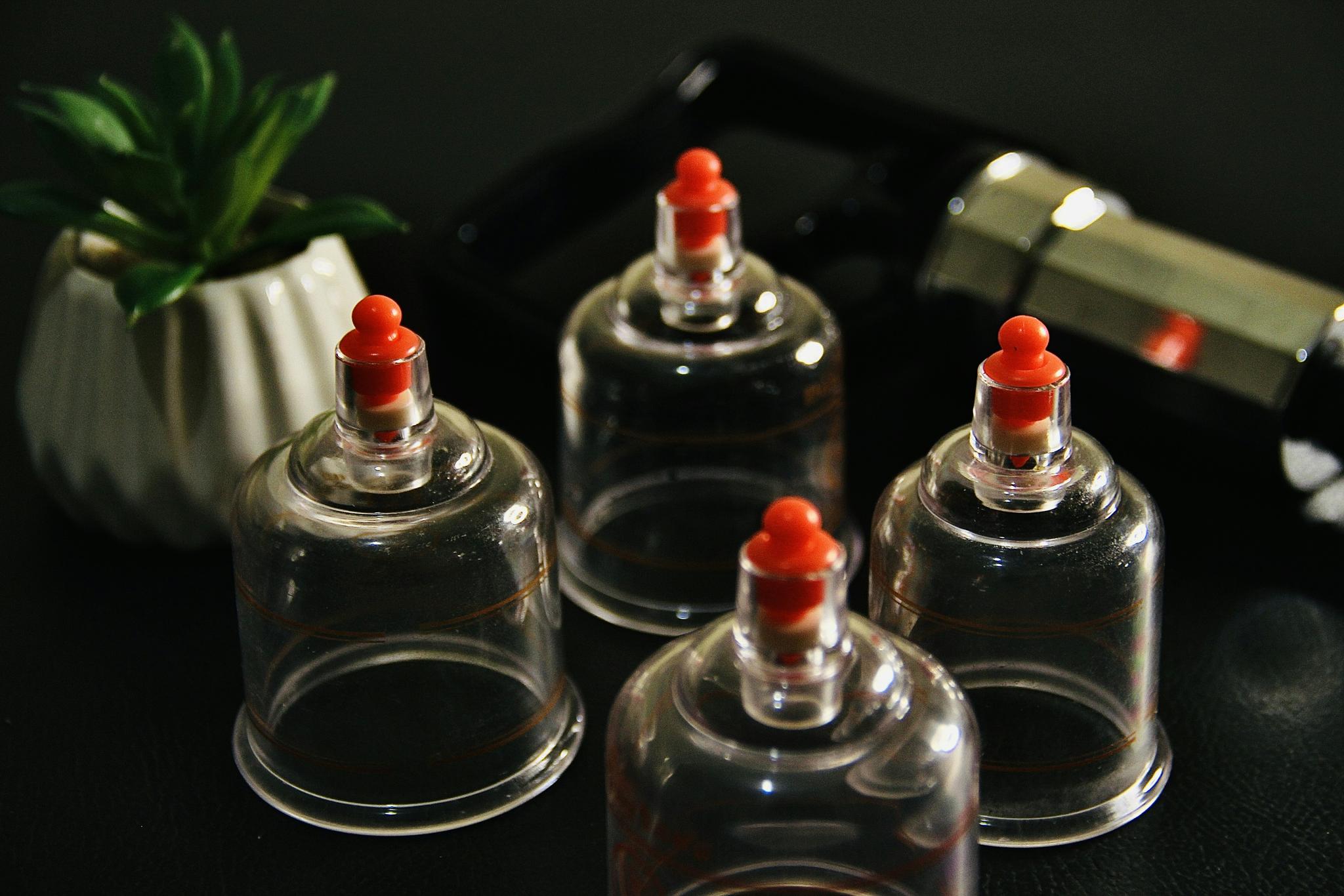 What Is Cupping?