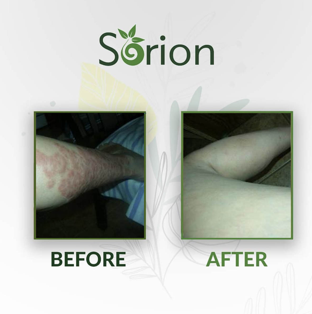 Sorion Herbal Cream with Coconut Oil, Neem, Turmeric, Pala Indigo