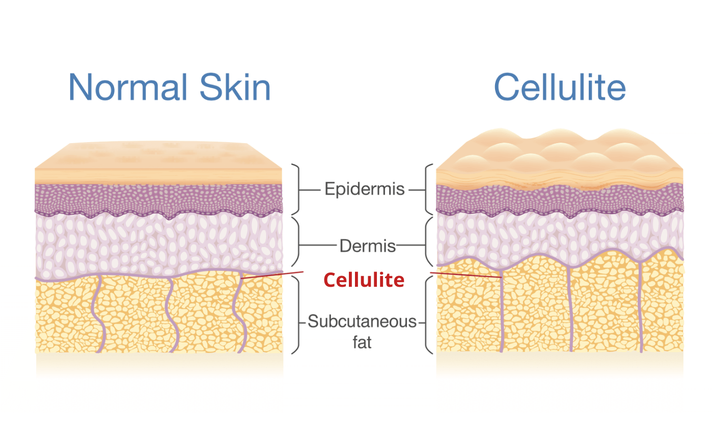 Cellulite, A Woman’s Curse: Understanding and Getting Rid of Cellulite
