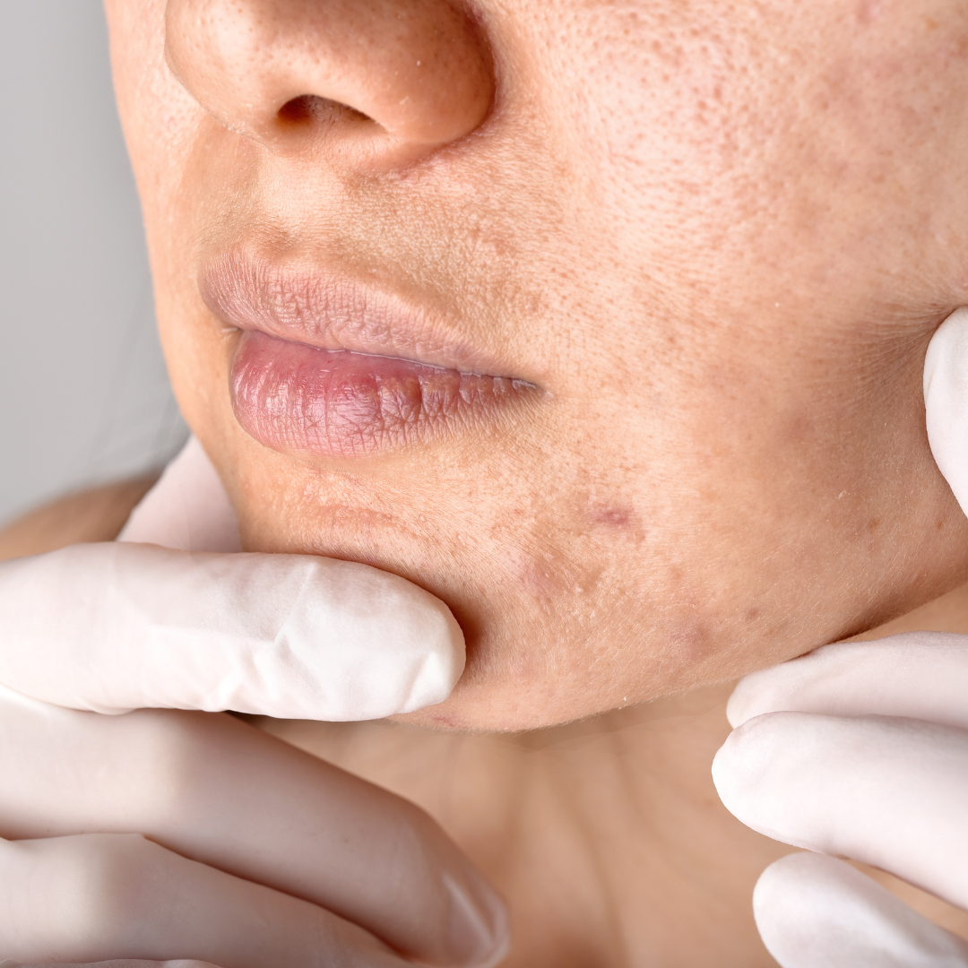 5 Dos and Don't You Should Know About Pimple & Its Marks