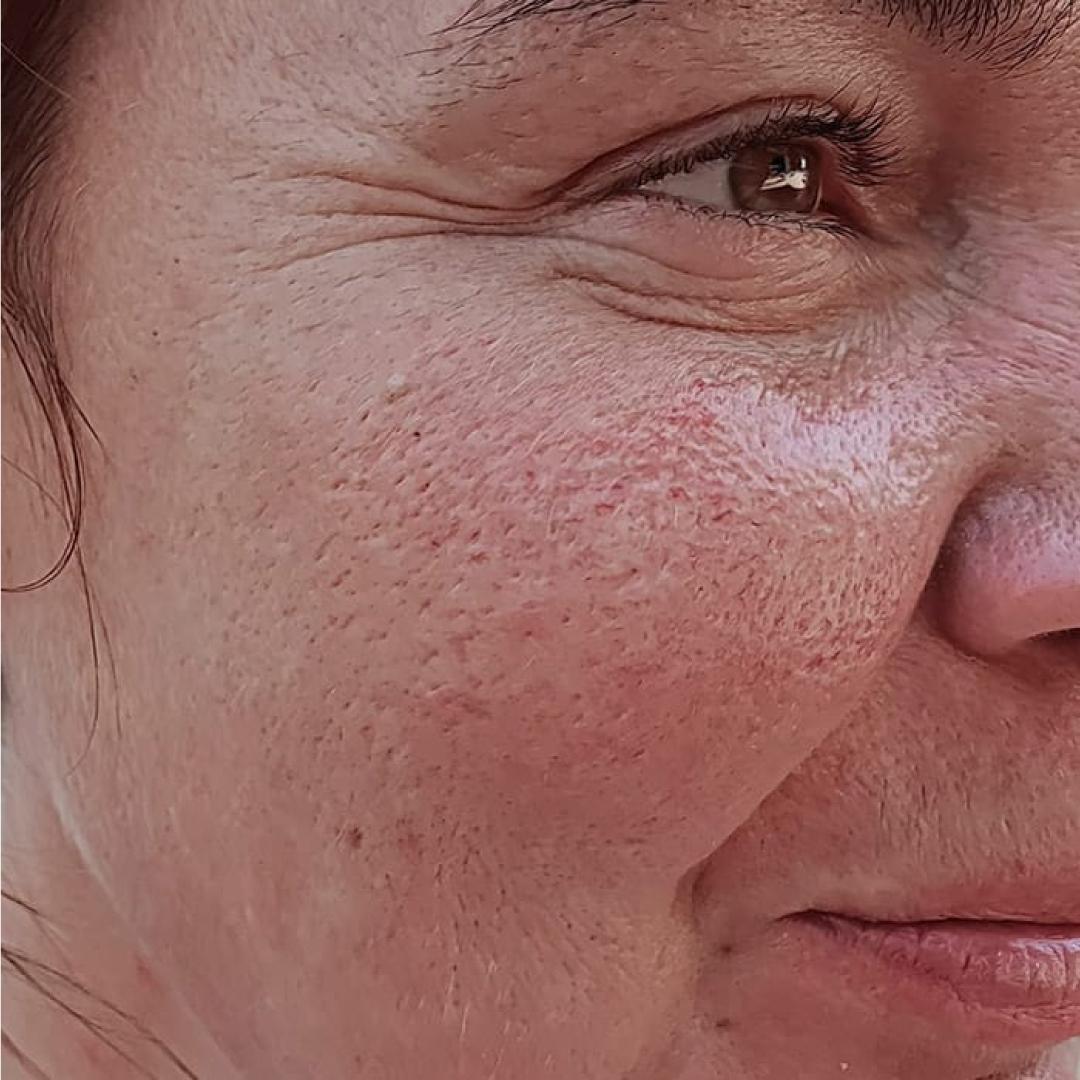 Bumpy Texture On Face Bumpy Texture On Face