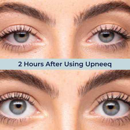 Upneeq Eye Drops - 30 Vials (Buy Online) | Skincare by Alana