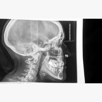 10 Fascinating Pictures of Body Jewelry in X-Rays