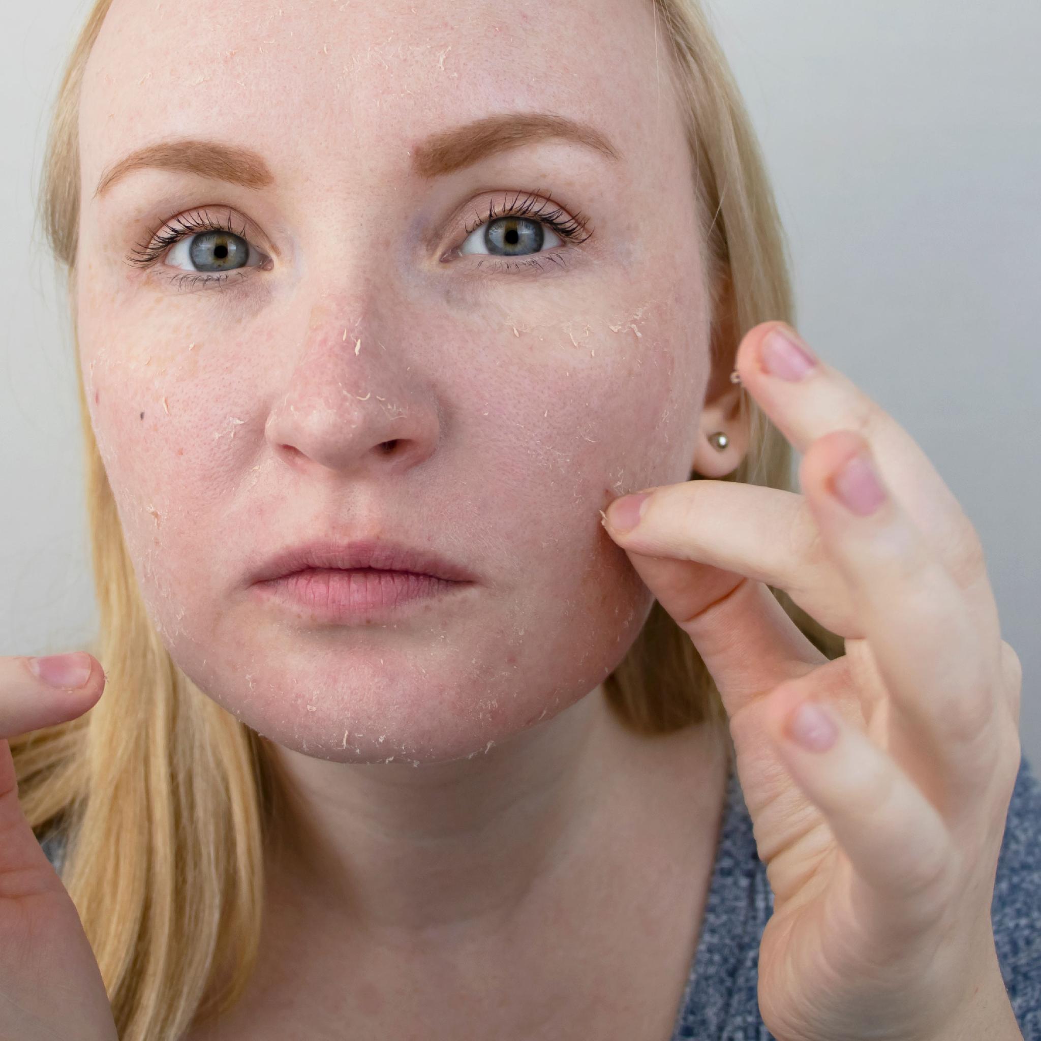 Everything About Seborrhea: Tips, Symptoms and Treatment