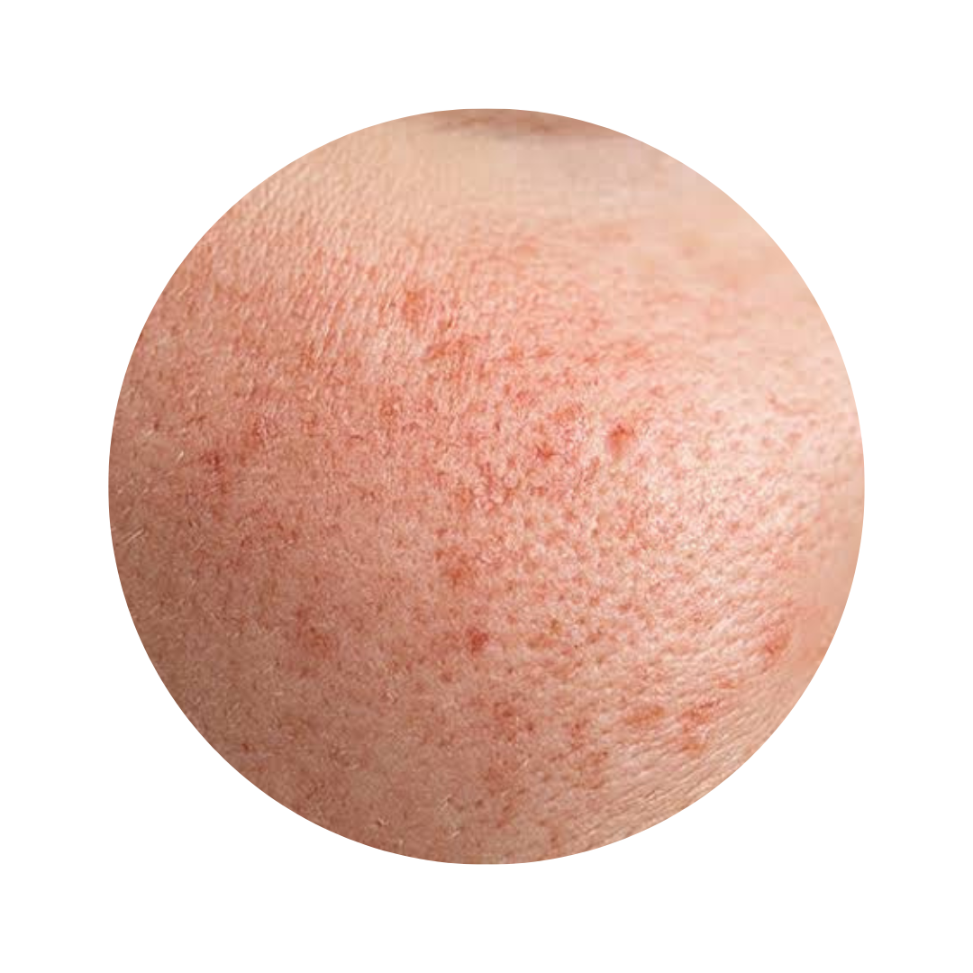 Everything About Open Pores: Causes, Types and Treatment