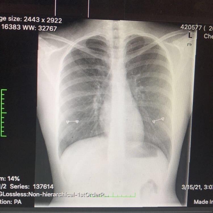 Four (4) More Fascinating Pictures of Body Jewelry in X-Rays – BodyCandy