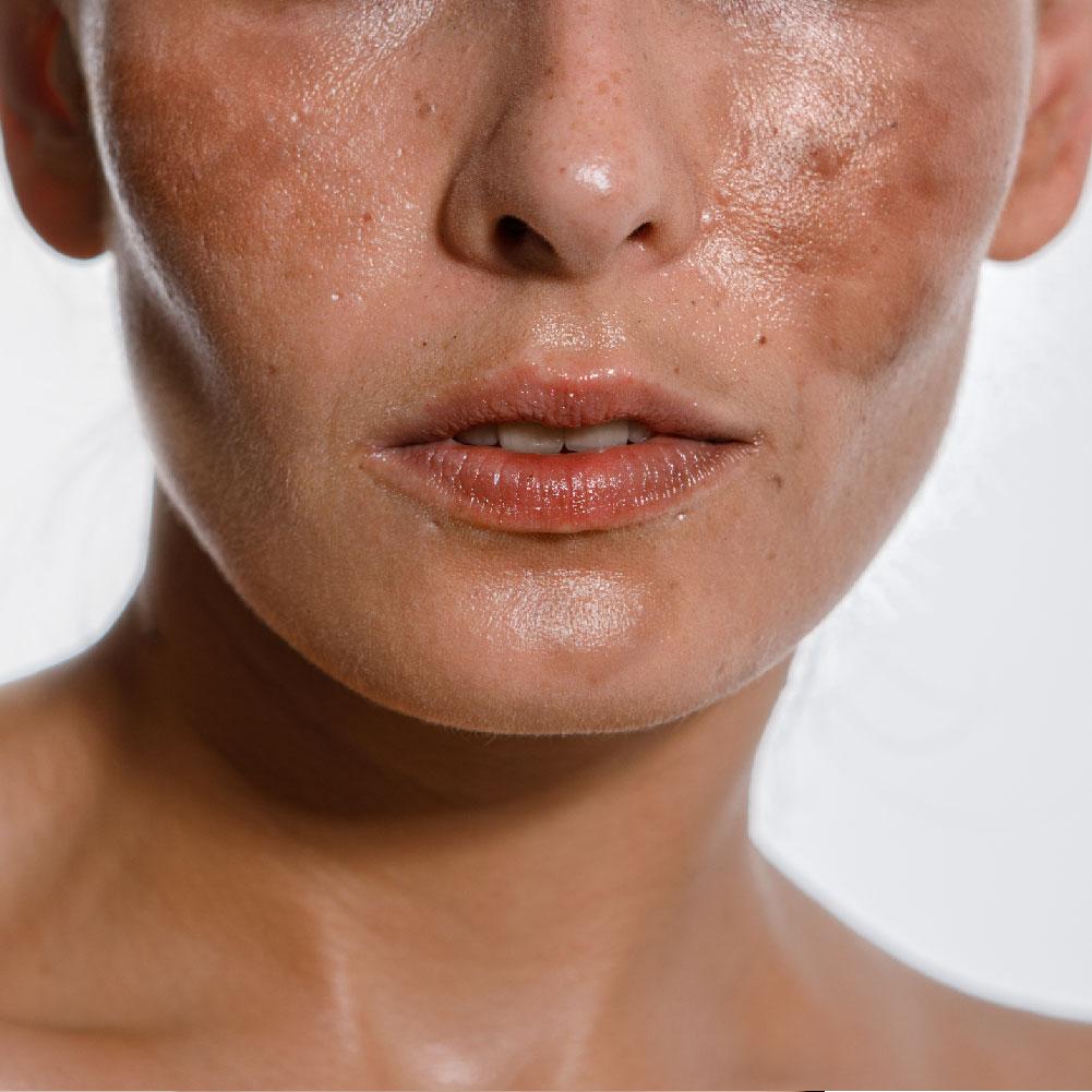 The Real Difference Between Acne Scarring & Pigmentation