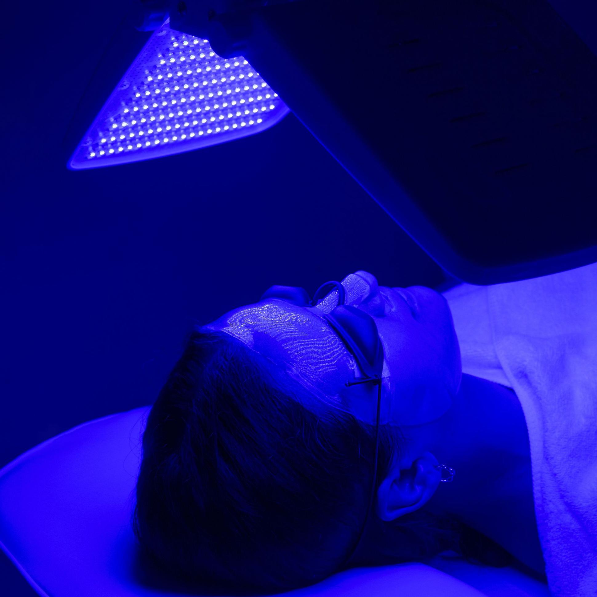 Blue Light and Hyperpigmentation