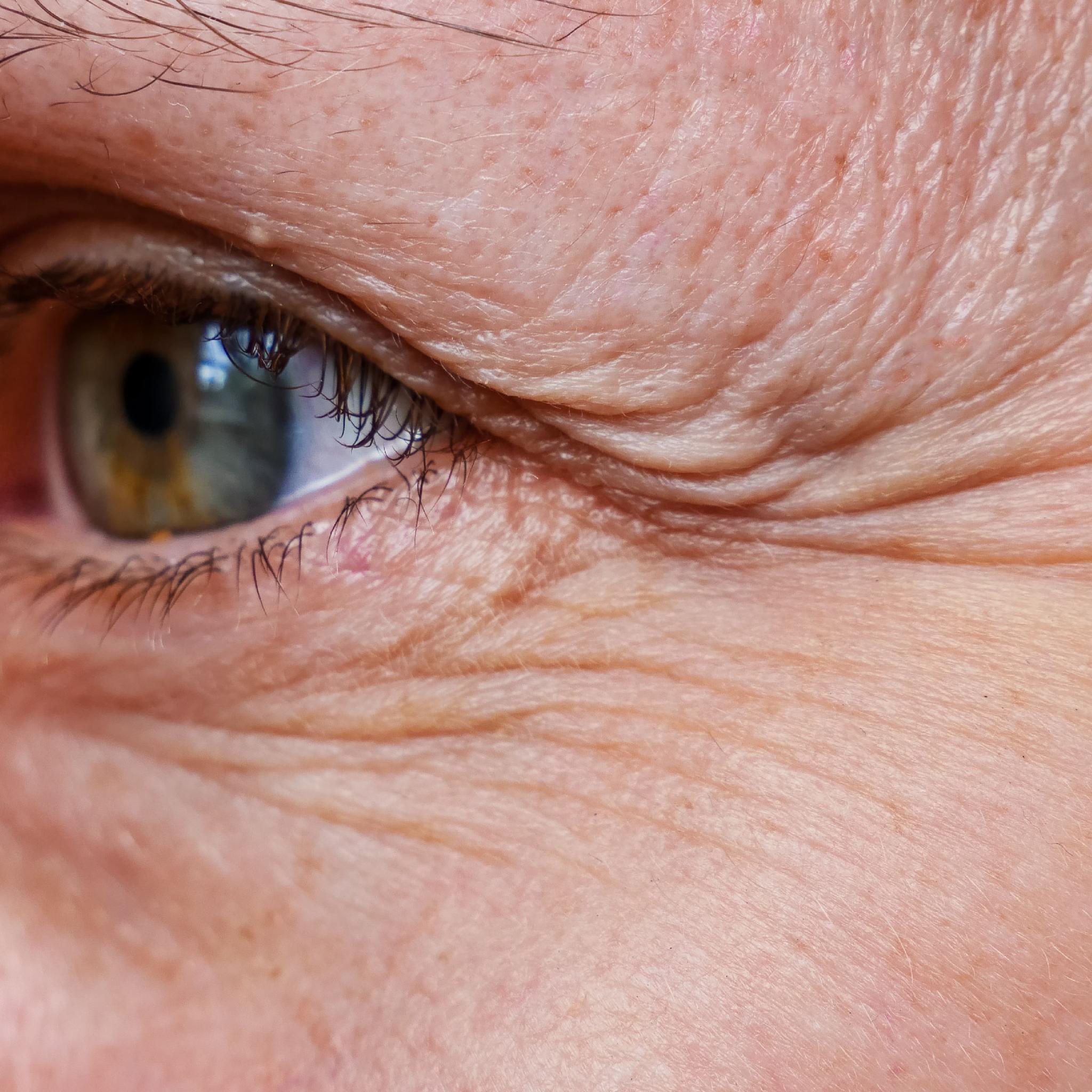 How To Spot The Different Types of Eye Wrinkles?