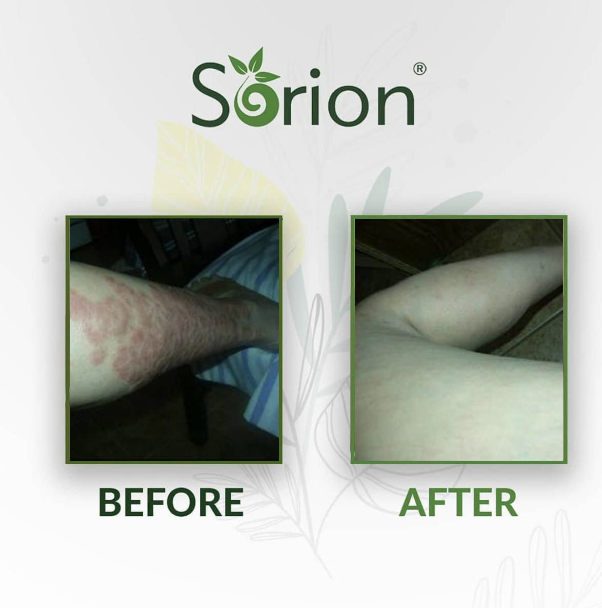 Sorion Herbal Cream with Coconut Oil, Neem, Turmeric, Pala Indigo