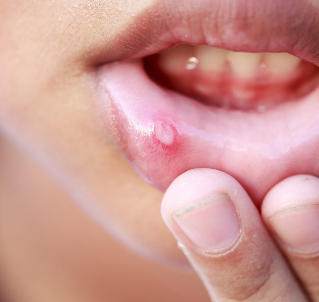 Afte kod djece – Hedera