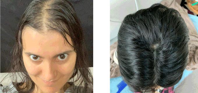Female Hair Loss can be helped