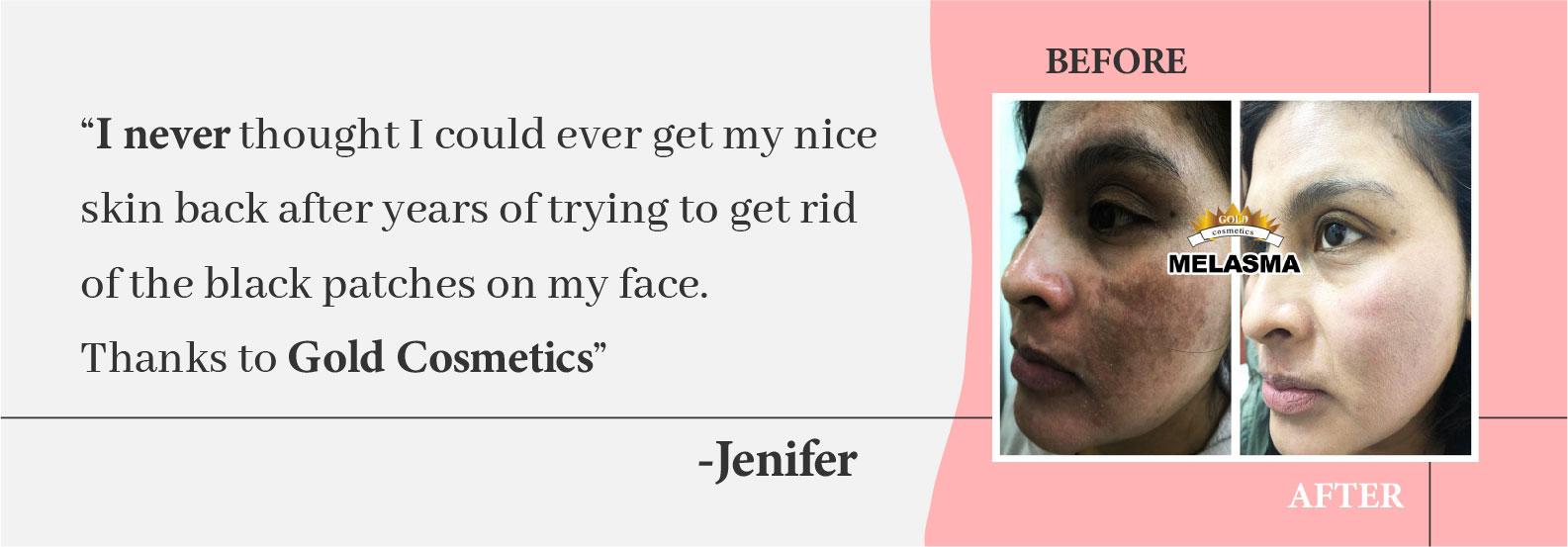 How To Get Rid of Melasma within Days