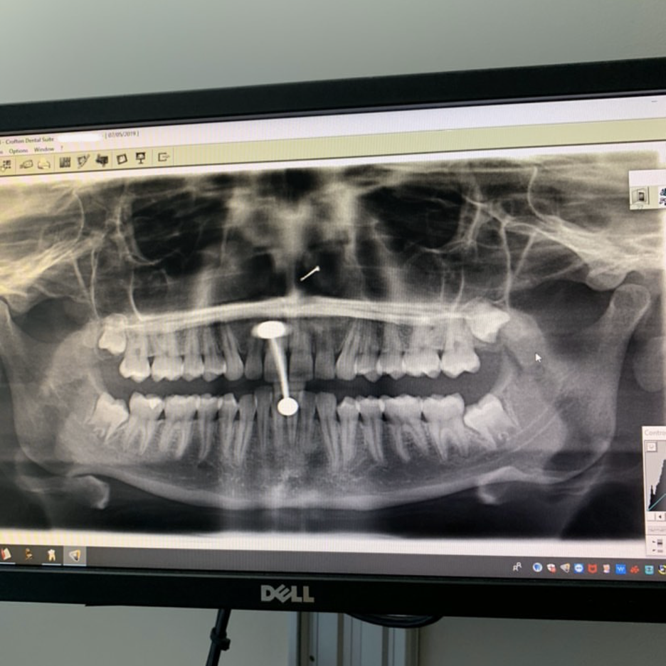 10 Fascinating Pictures of Body Jewelry in X-Rays – BodyCandy