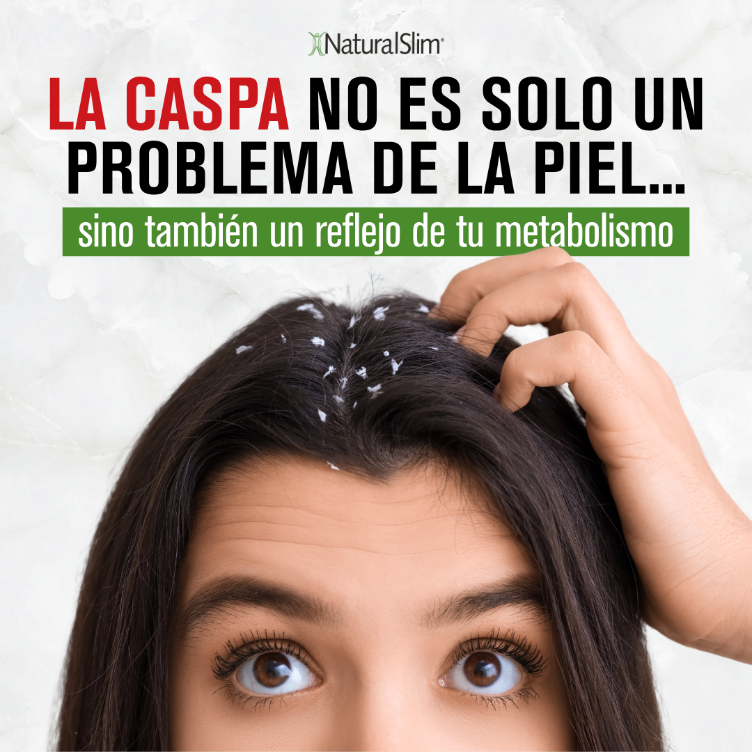 Aprende a apoyar a tu metabolismo para eliminar la caspa – NaturalSlim USA
