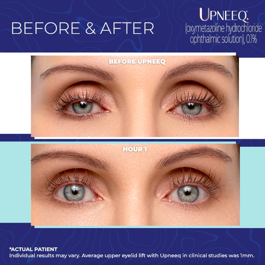 Upneeq Eye Drops - 30 Vials (Buy Online) | Skincare by Alana