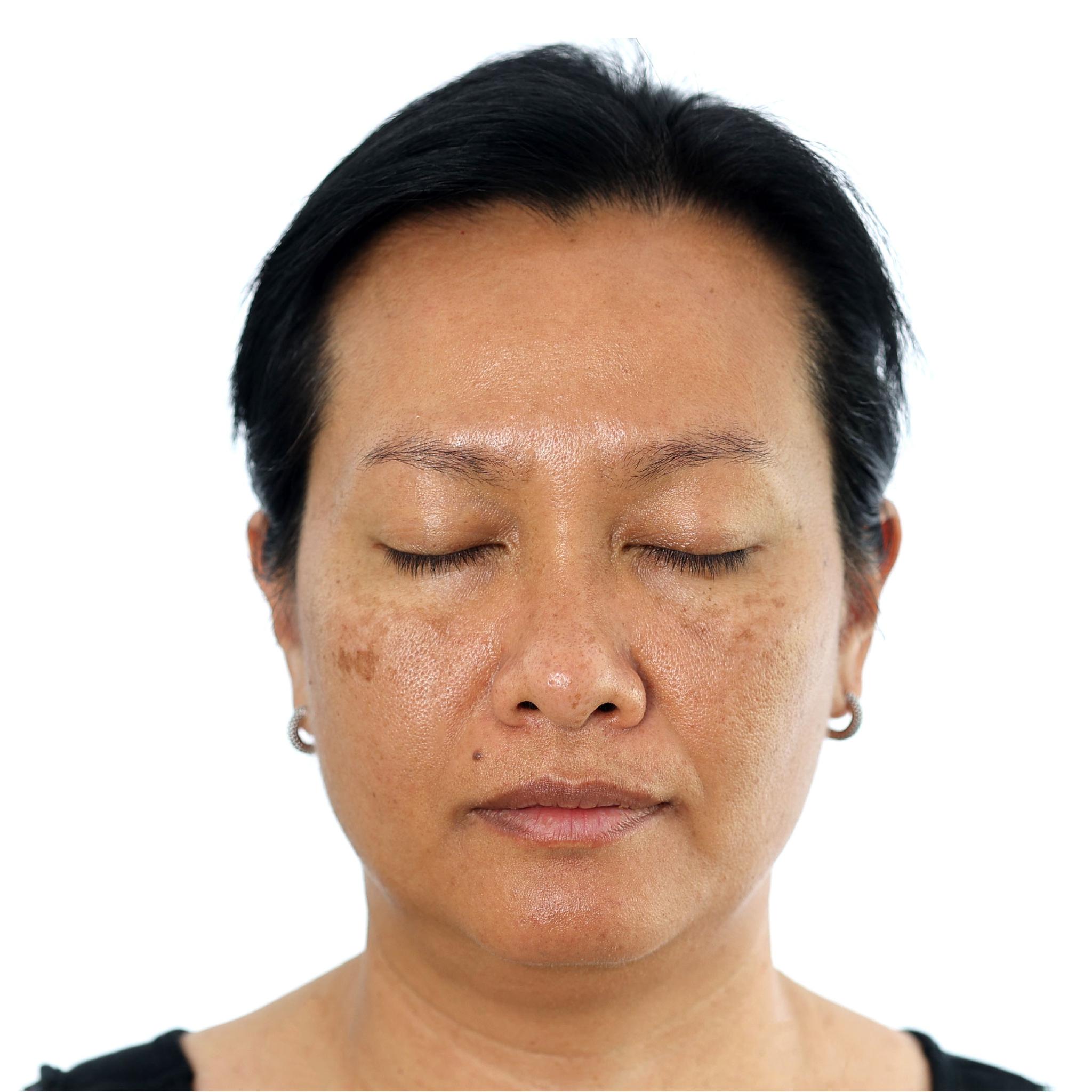 The 3 Main Types of Melasma You Should Avoid.