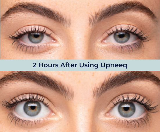 Upneeq Eye Drops - 30 Vials (Buy Online) | Skincare by Alana