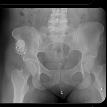 10 Fascinating Pictures of Body Jewelry in X-Rays – BodyCandy