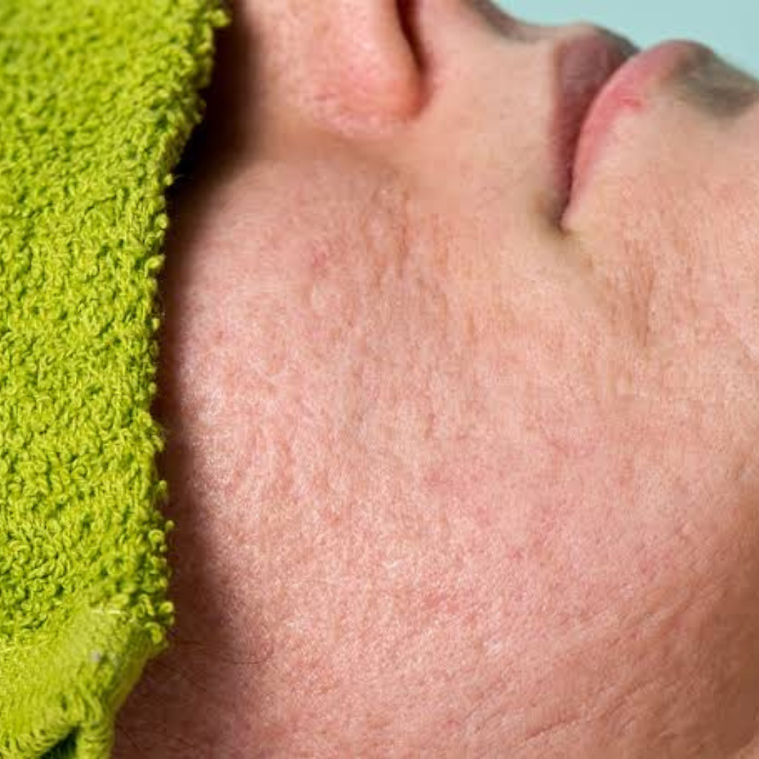 Everything About Open Pores: Causes, Types and Treatment