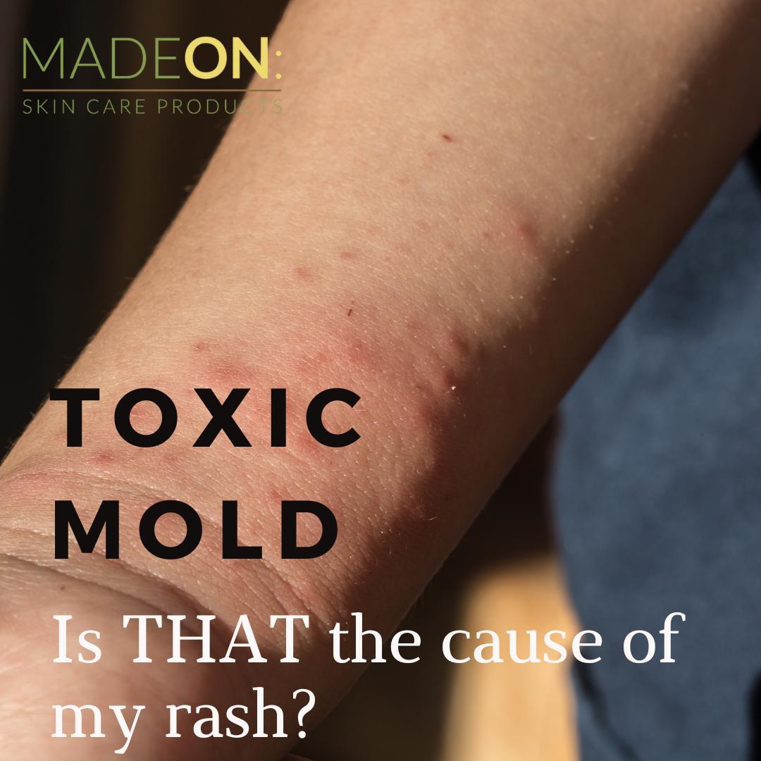 Symptoms of Toxic Mold Exposure – MadeOn Skin Care