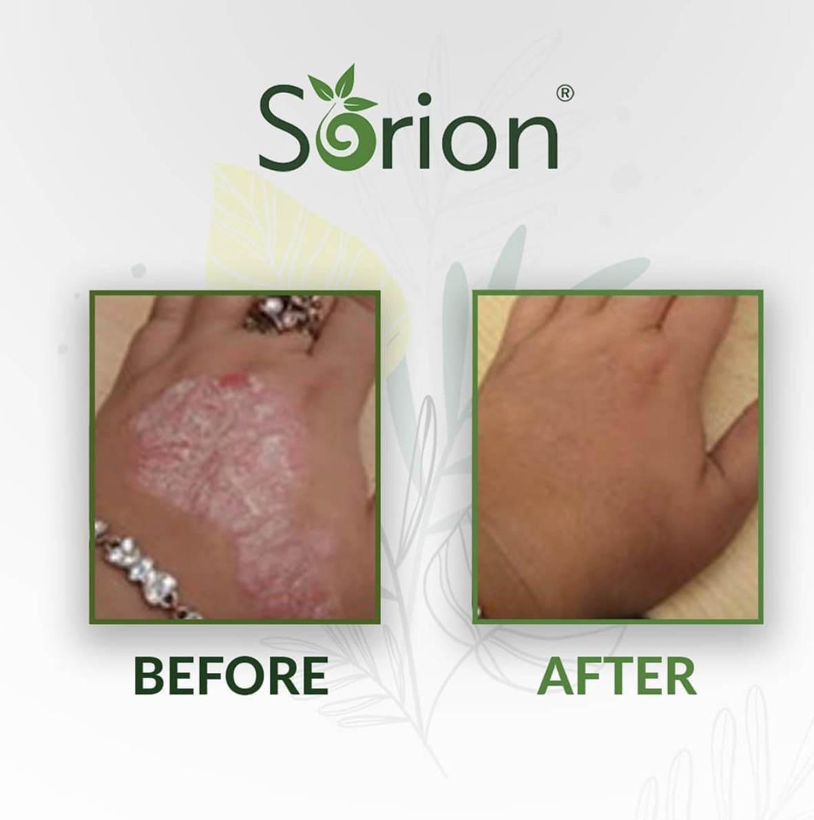 Sorion Herbal Cream with Coconut Oil, Neem, Turmeric, Pala Indigo