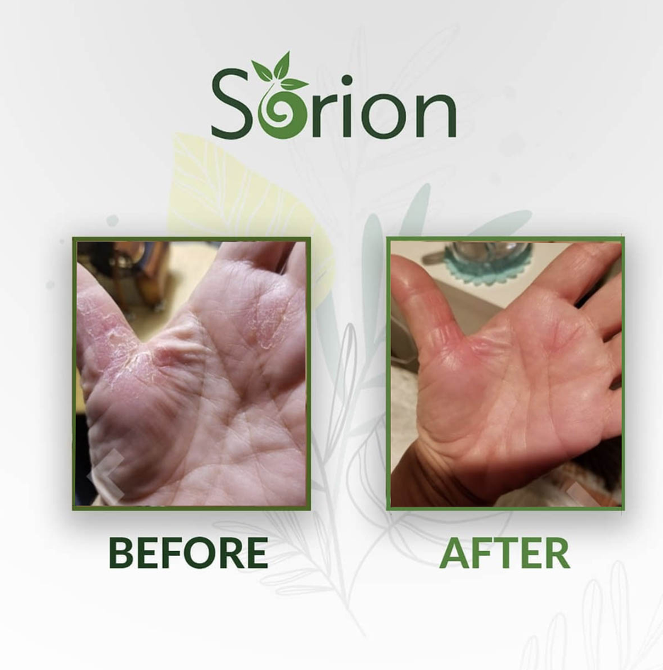 Sorion Herbal Cream with Coconut Oil, Neem, Turmeric, Pala Indigo