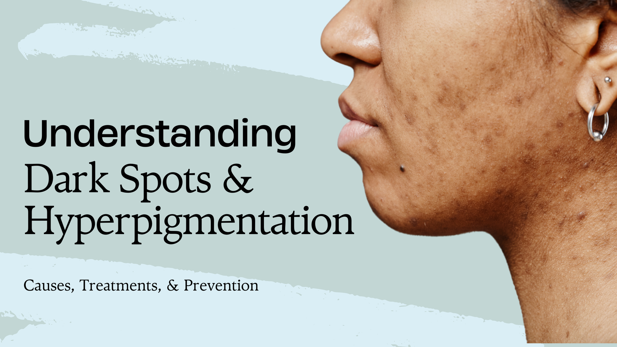 What You Should Know About Dark Spots?