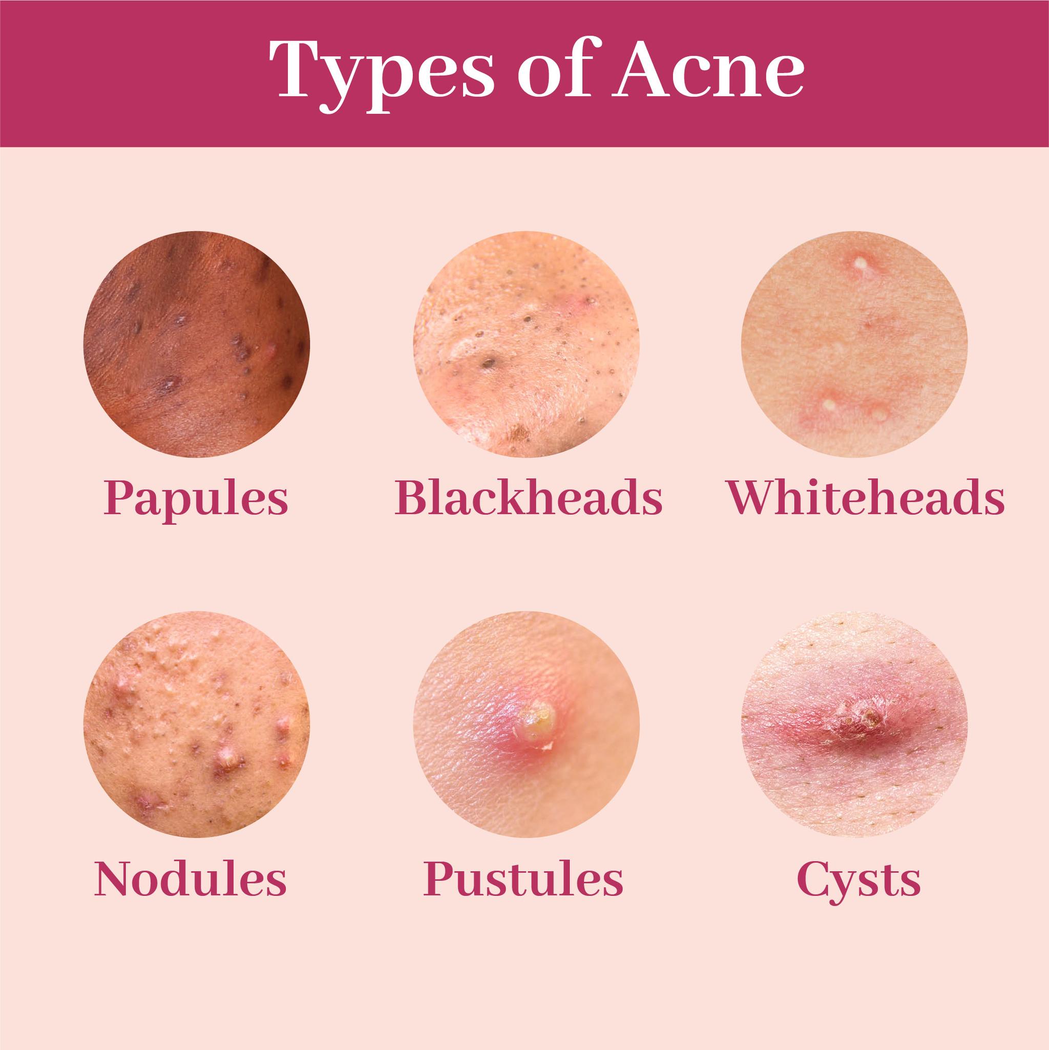 Simple and Effective Routine Treatment for Acne