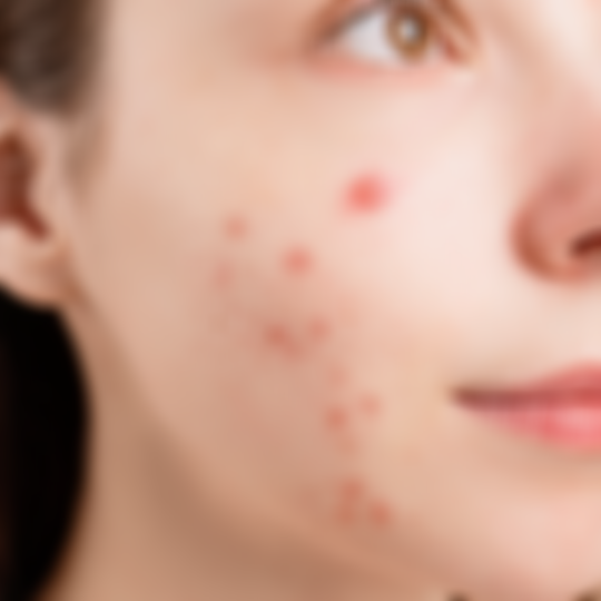 5 Dos and Don't You Should Know About Pimple & Its Marks