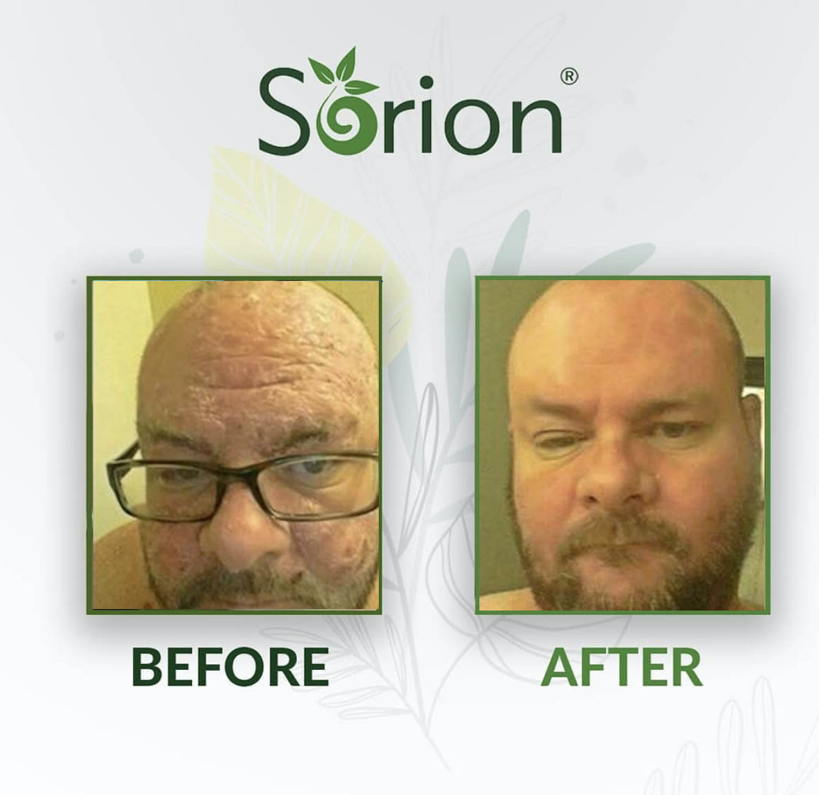 Sorion Herbal Cream with Coconut Oil, Neem, Turmeric, Pala Indigo