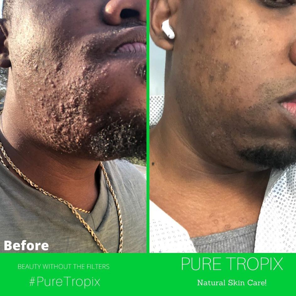 Ingrown Hair Product Page – Pure Tropix
