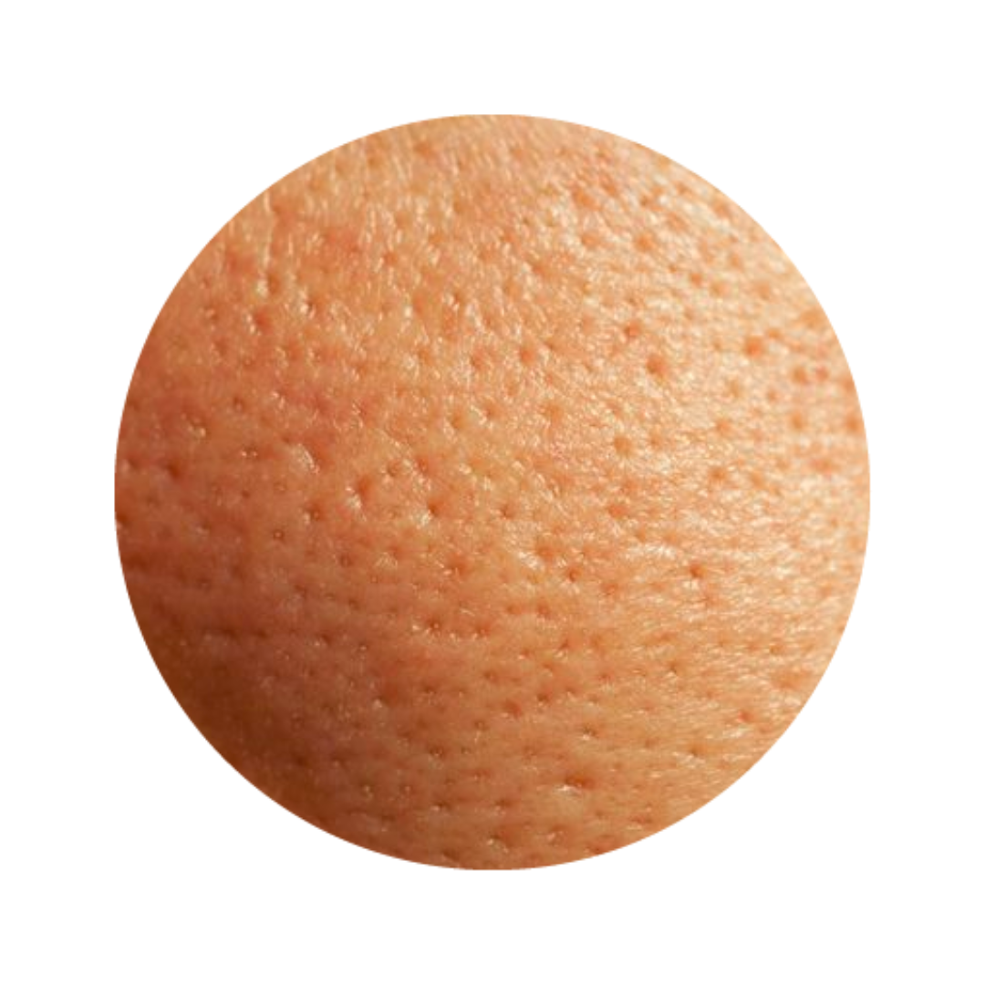 Everything About Open Pores: Causes, Types and Treatment