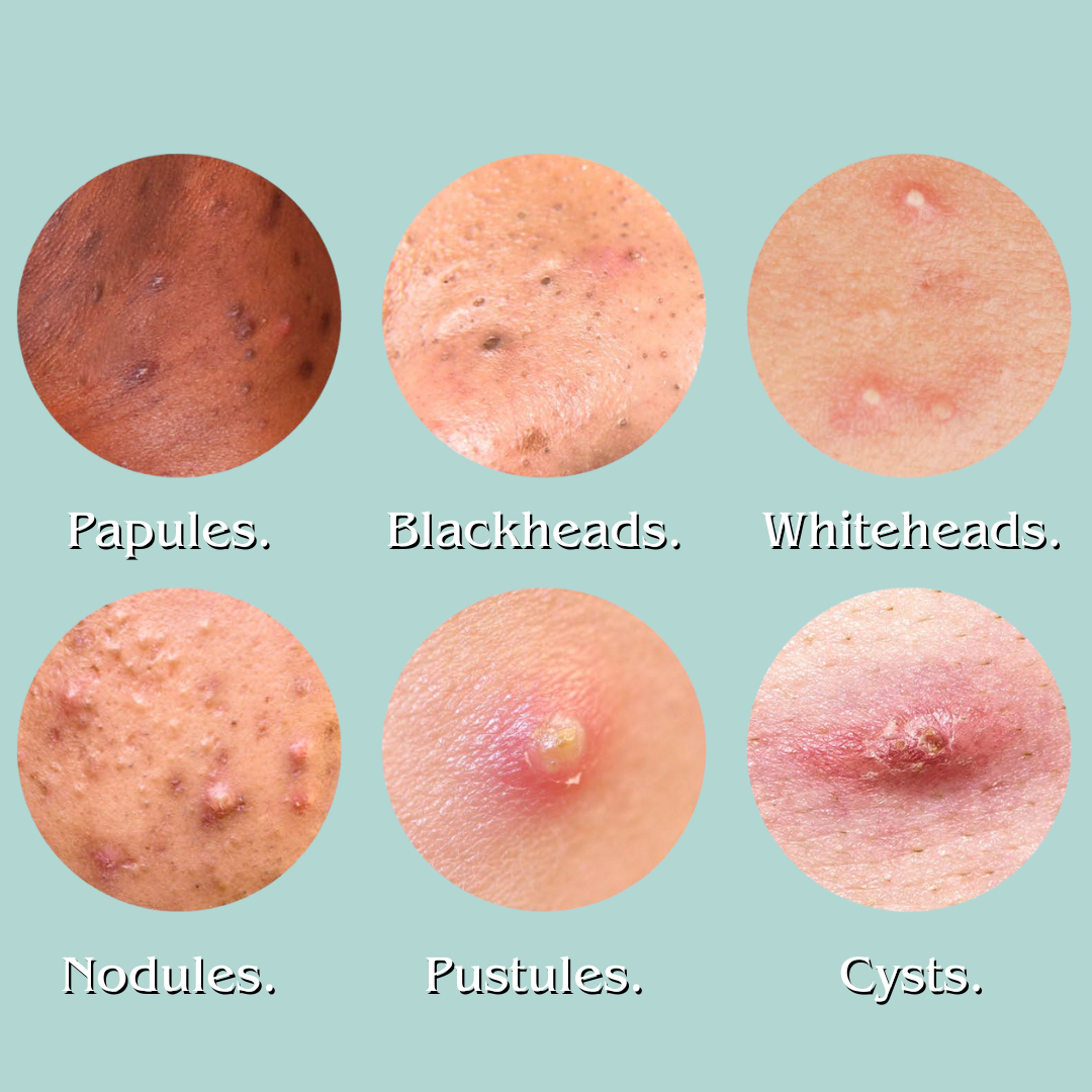 Everything You Need To Know About Acne