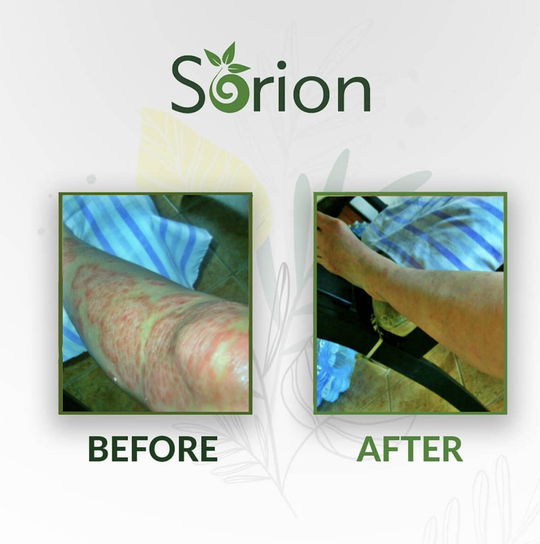 Sorion Herbal Cream with Coconut Oil, Neem, Turmeric, Pala Indigo