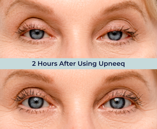 Upneeq Eye Drops - 30 Vials (Buy Online) | Skincare by Alana