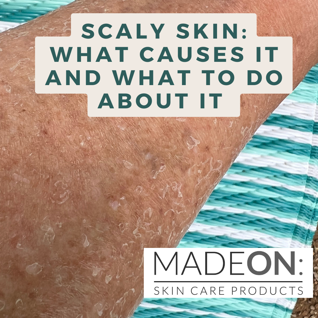 Dry, Flaky Scaly Skin: Causes and Solutions – MadeOn Skin Care