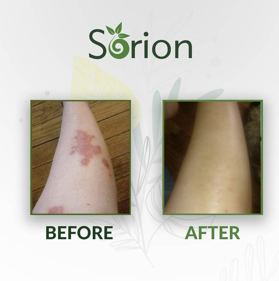 Sorion Herbal Cream with Coconut Oil, Neem, Turmeric, Pala Indigo
