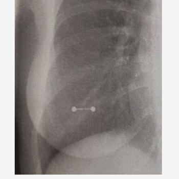 10 Fascinating Pictures of Body Jewelry in X-Rays – BodyCandy