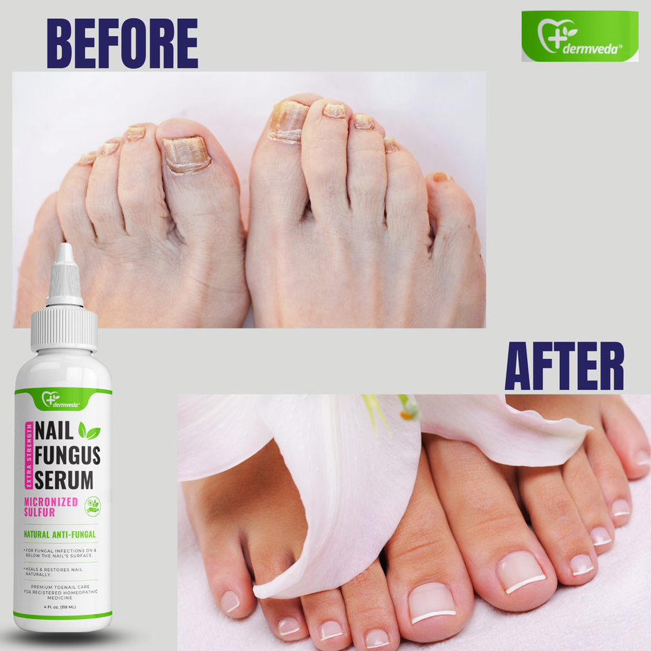 Dermveda™ Toenail Fungus Treatment–Micronized Sulfur Formula