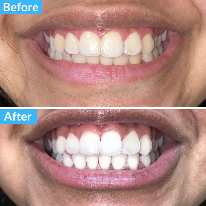 Polar MD Teeth Whitening Kit