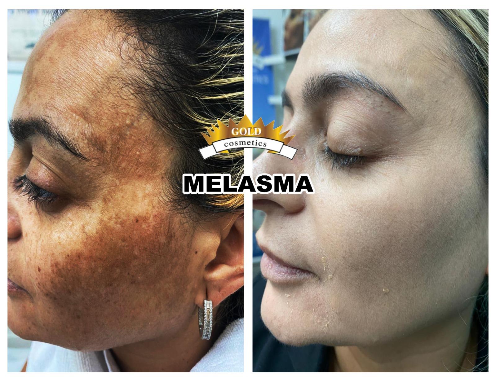 The Real Difference Between Acne Scarring & Pigmentation