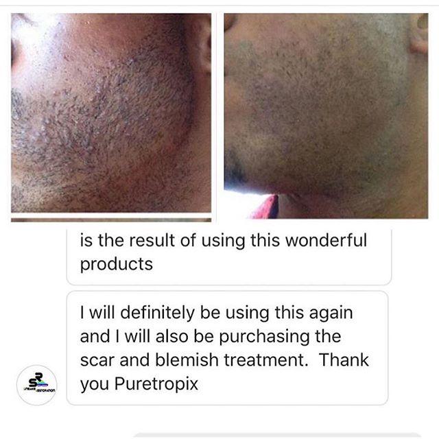 Ingrown Hair Product Page – Pure Tropix