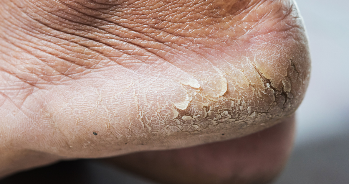 Foot Challenge – MadeOn Skin Care