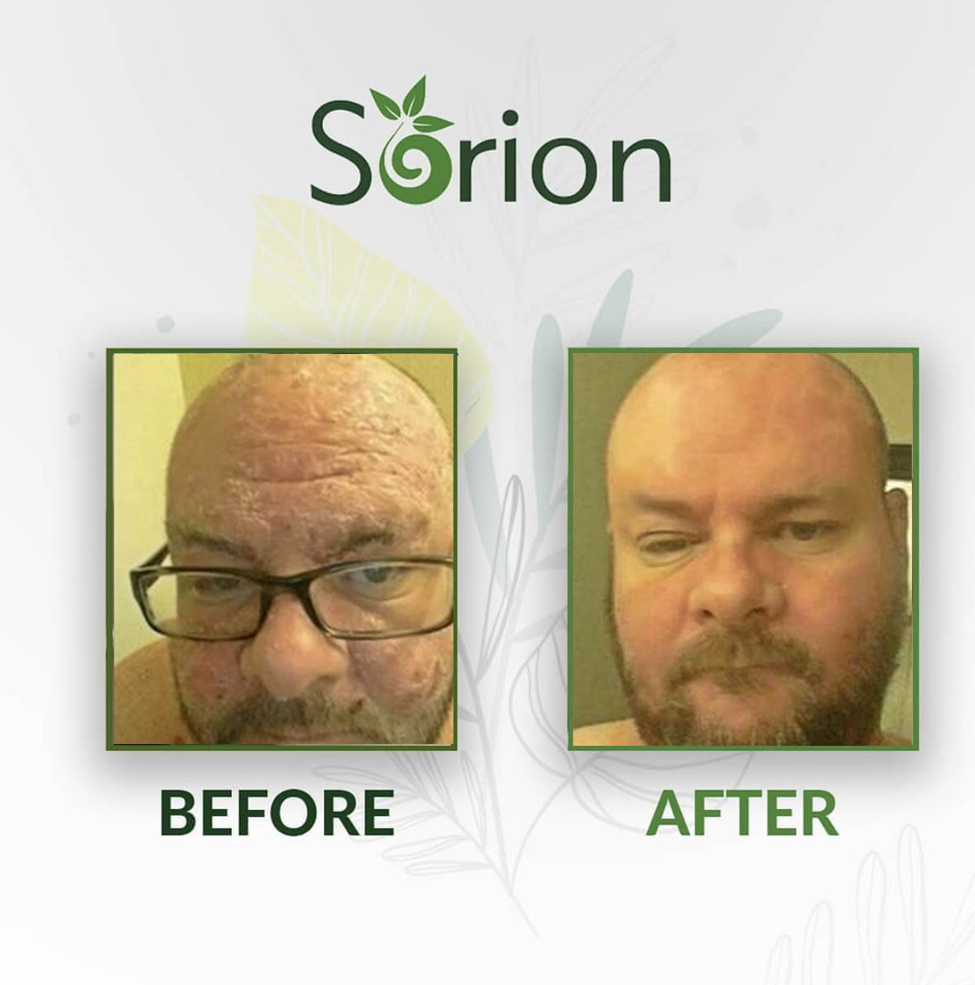 Sorion Herbal Cream with Coconut Oil, Neem, Turmeric, Pala Indigo